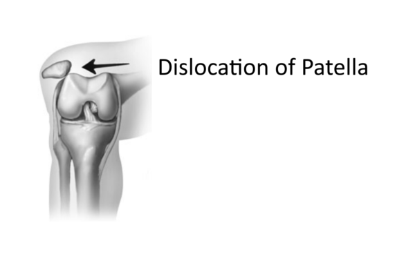 Patella Dislocations and Treatment Archives - Aastha joints Blog